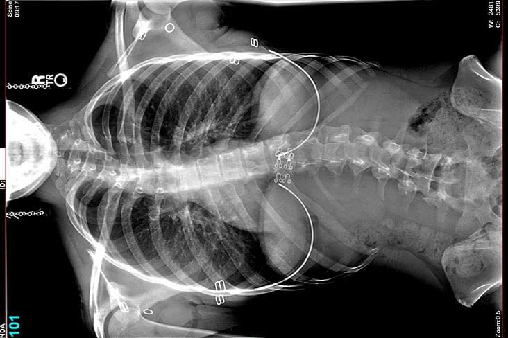 Spine Curvature Disorders: What are the Different Types? – Orthopaedic ...